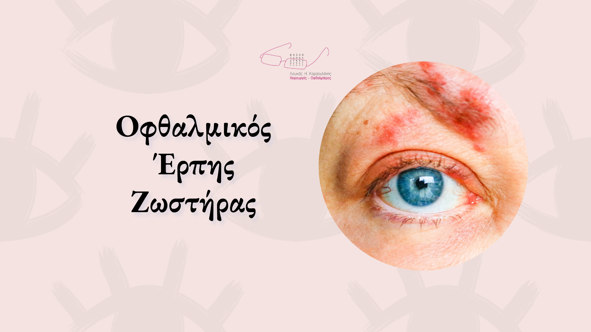 Οφθαλμικός Έρπης Ζωστήρας (Herpes Zoster Ophthalmicus) - Λουκάς Καραογλάνης